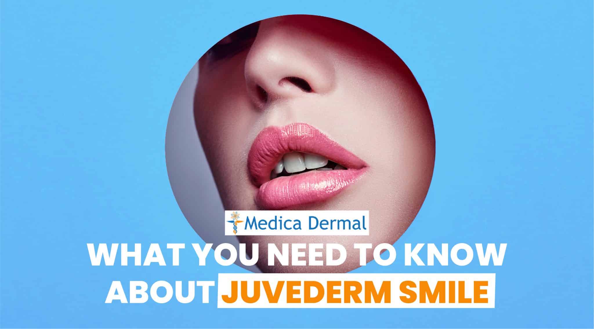 What You Need to Know About Juvederm Ultra Smile - Medica Dermal